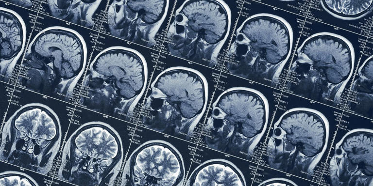 People working in shifts undergo gradual shrinkage of two brain regions