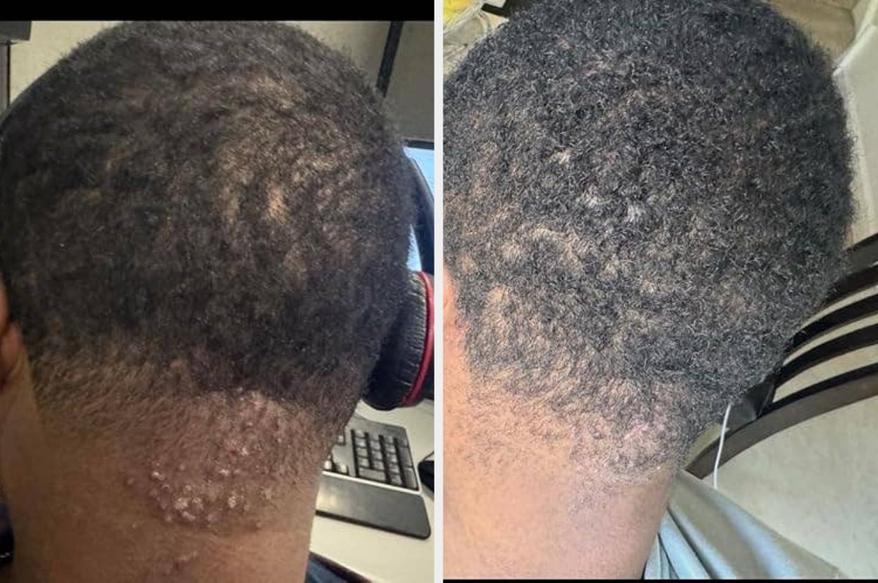 15 products reviewers say helped them get rid of ingrown hairs and ...