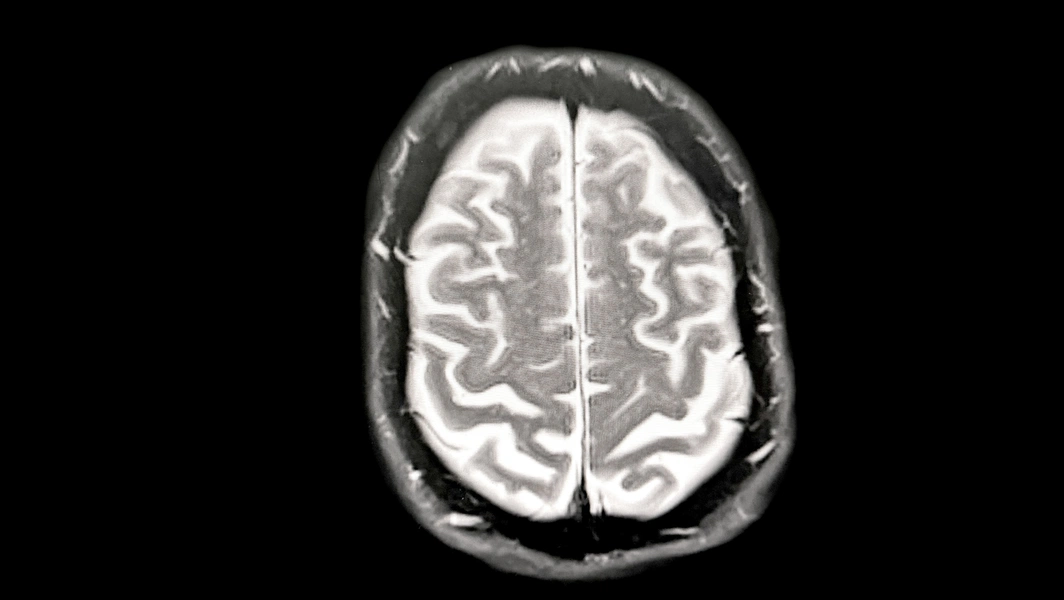 Slower handwriting under dictation may flag early dementia