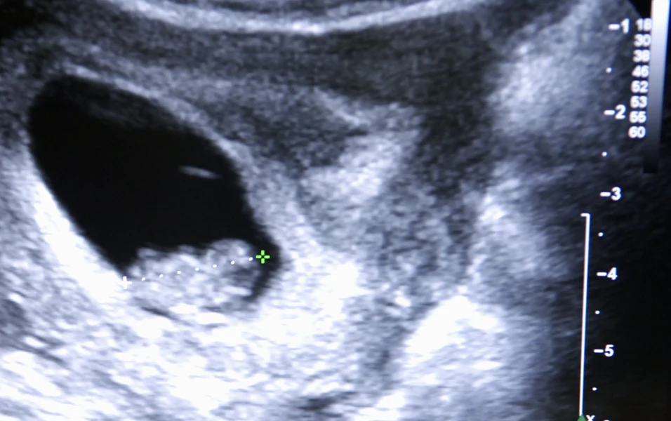 Making sense of your pregnancy due date
