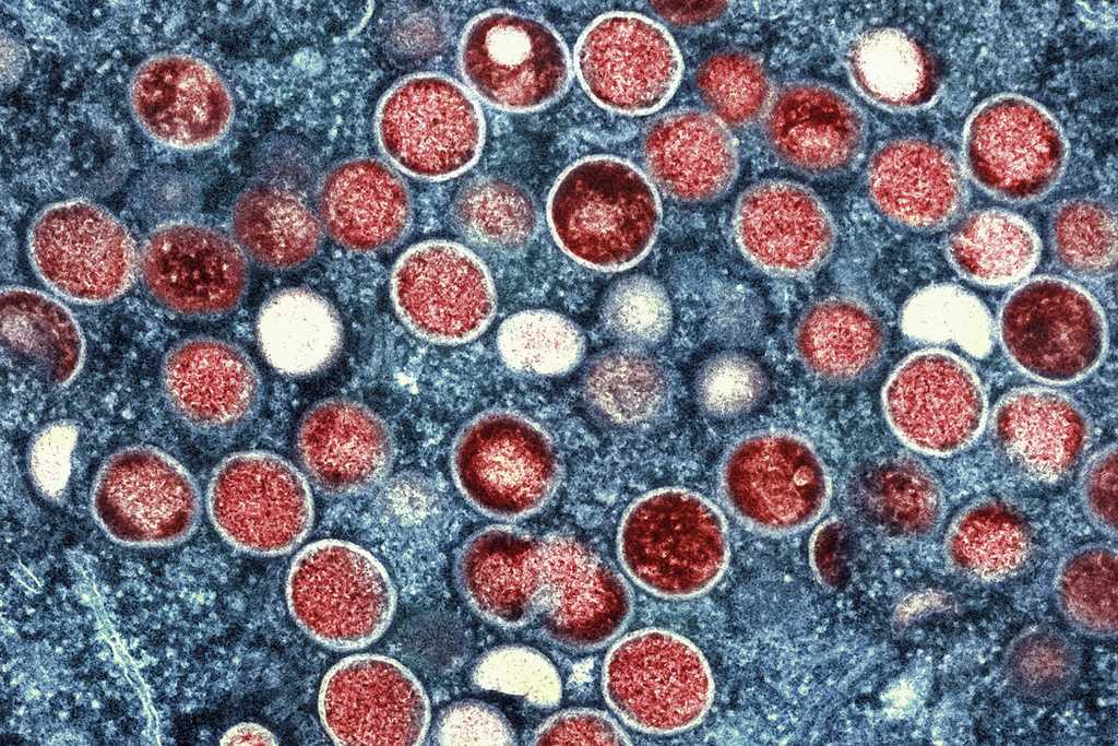 Wisconsin reports first MPOX cases of 2026