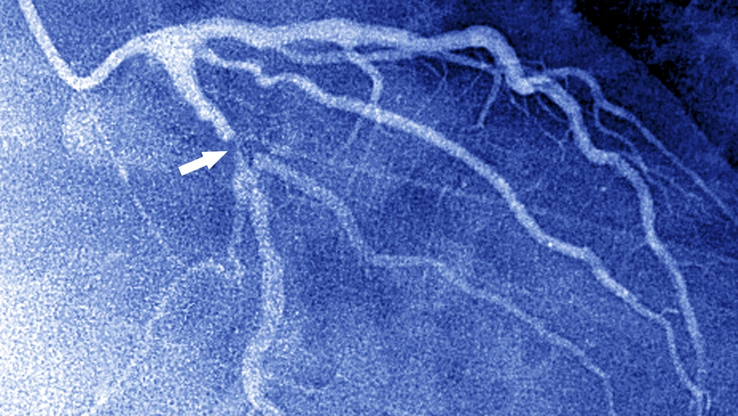 Spotting the signs of stable vs unstable angina