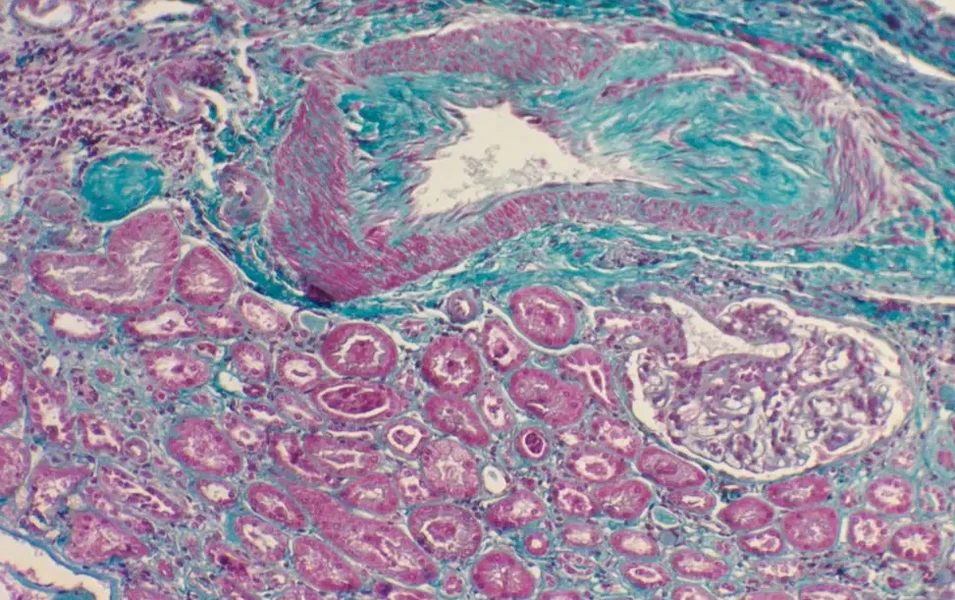 Why kidney health needs our attention now
