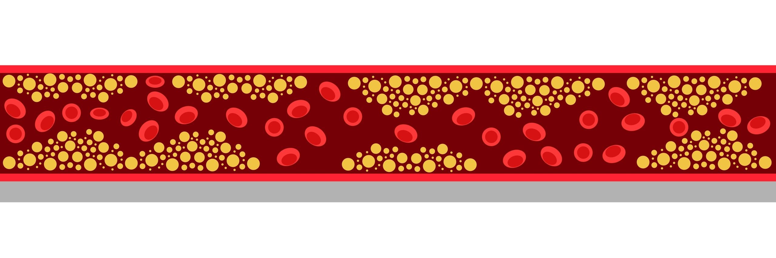 Tryngolza shows efficacy in severe hypertriglyceridemia as approval ...