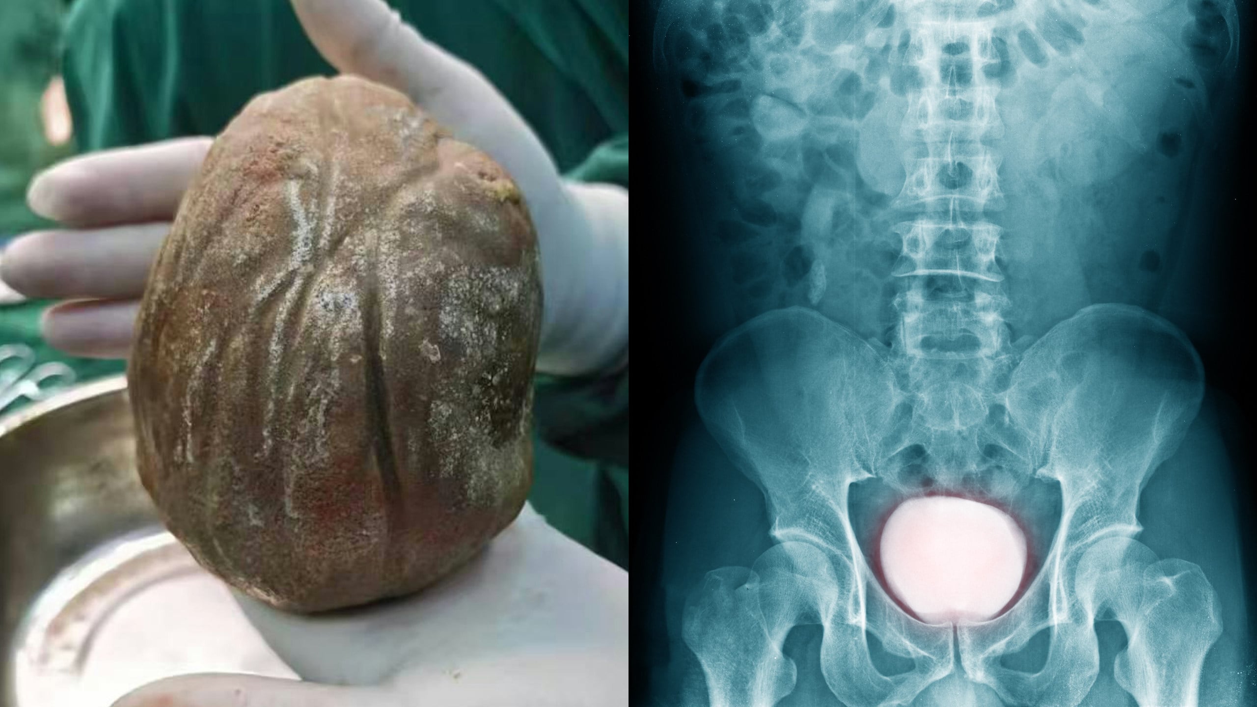 Chinese man who suffered painful urination for 3 years discovers 1.3kg ...