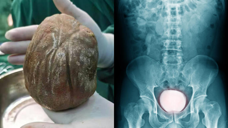 Chinese man who suffered painful urination for 3 years discovers 1.3kg ...