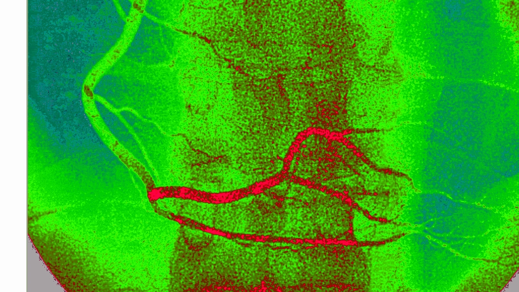 Spotting the signs of stable vs unstable angina
