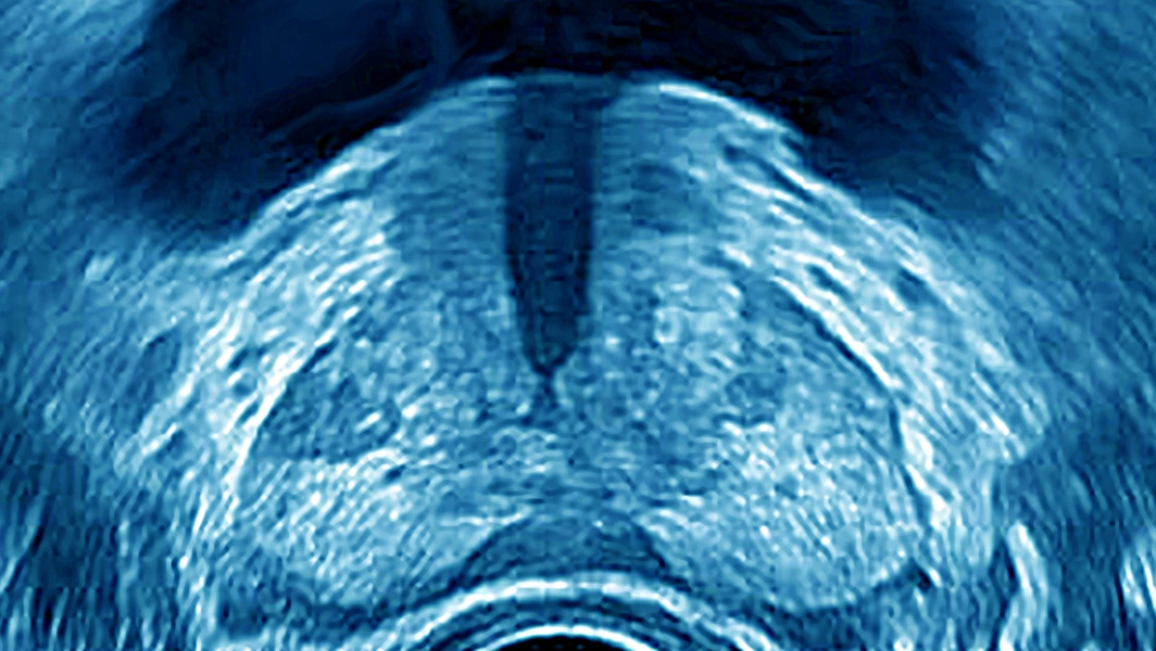 PSA testing decoded for men’s health choices