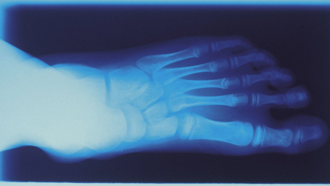 Bunion care tips every active woman should know