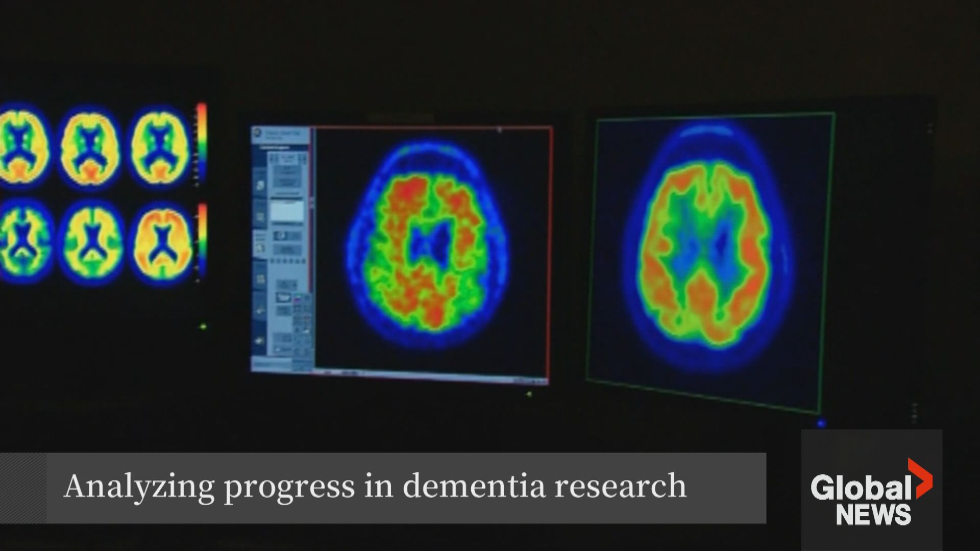 Newly approved treatment for people with early on-set Alzheimer’s disease
