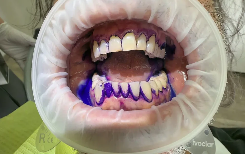 Experts warn common daily habits silently damage gum health