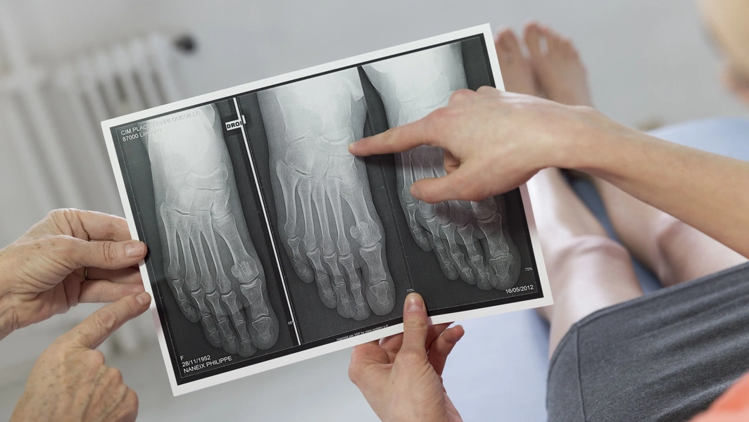 Bunion care tips every active woman should know