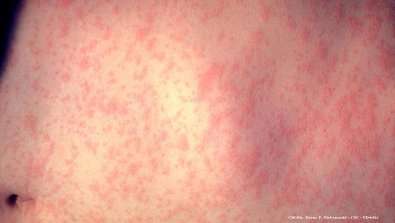 Bangladesh measles outbreak kills over 500 children