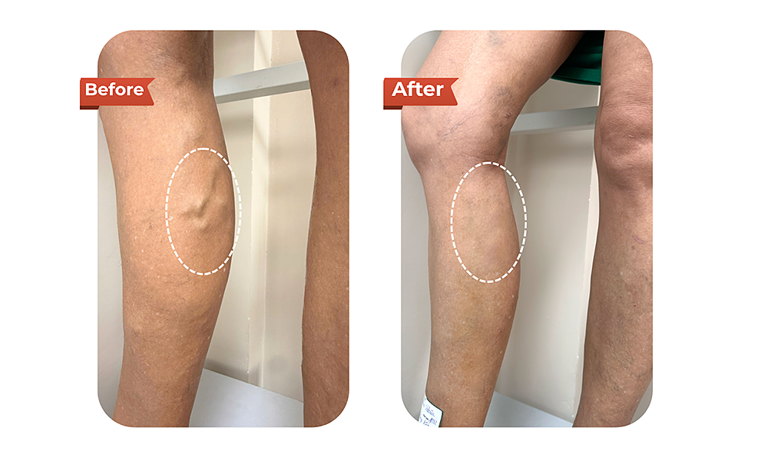 Foreign tourist undergoes varicose vein treatment in Vietnam after ...