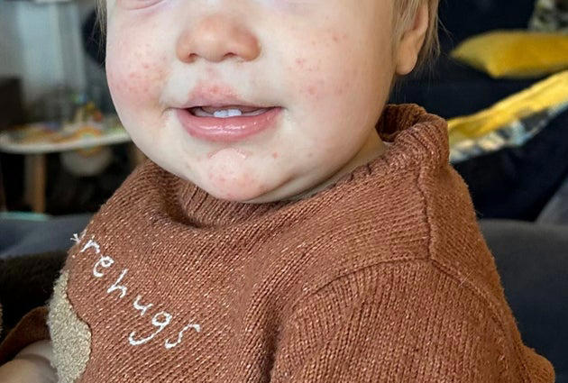 Chickenpox, impetigo or hand, foot and mouth? Dermatologist shares how ...