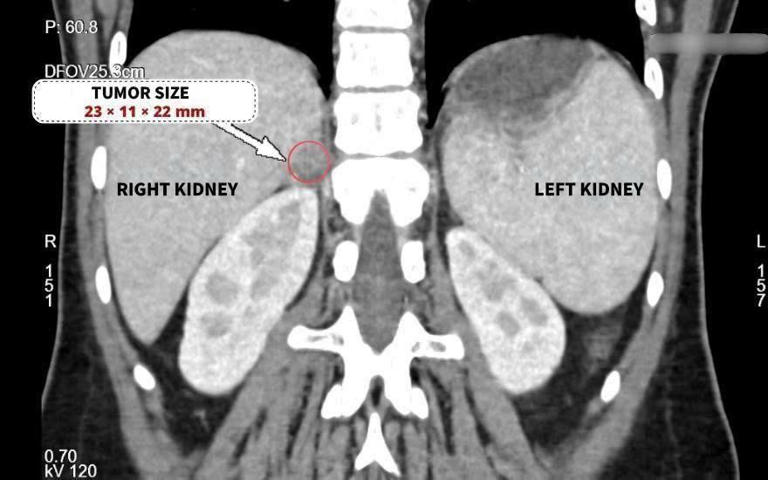 Ukrainian patient treated in Vietnam after four years of unexplained ...