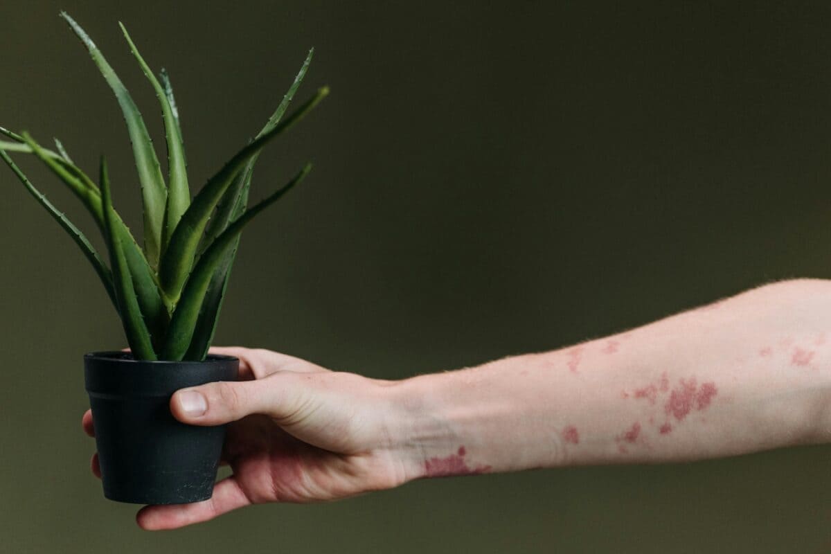 From itching to rash: Understanding the early signs of eczema in summer