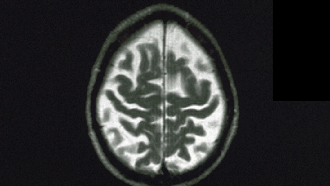 AI maps brain's waste-clearing system at two distinct speeds