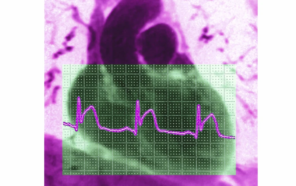 Major trial questions beta blocker benefits after uncomplicated heart ...