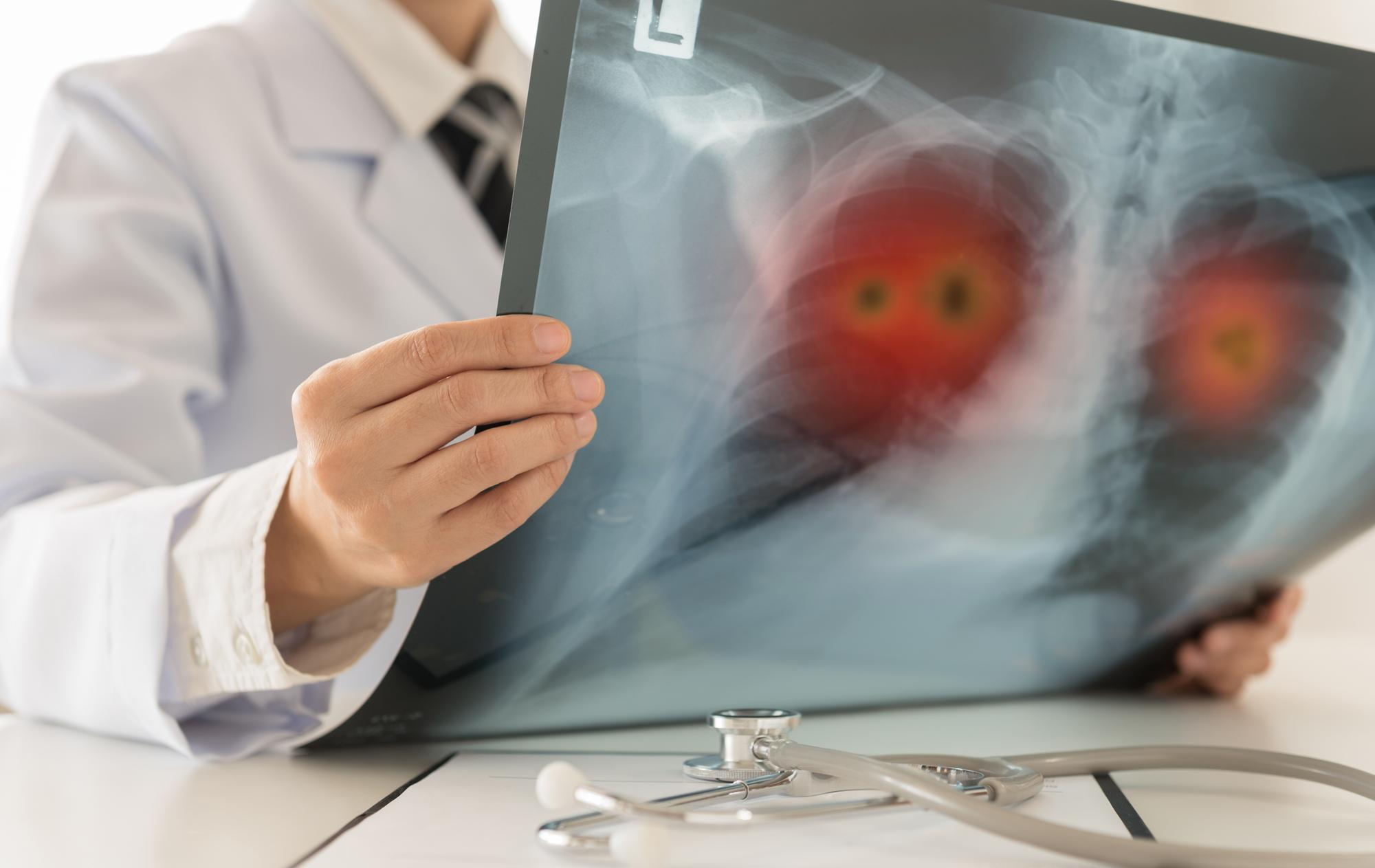 Hundreds get earlier lung cancer diagnosis thanks to new screening ...