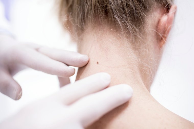 The red flags for skin cancer you should never ignore