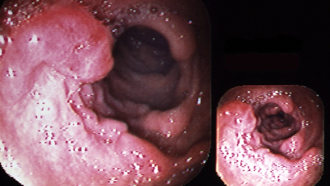 ACS adds blood and stool tests to colorectal screening
