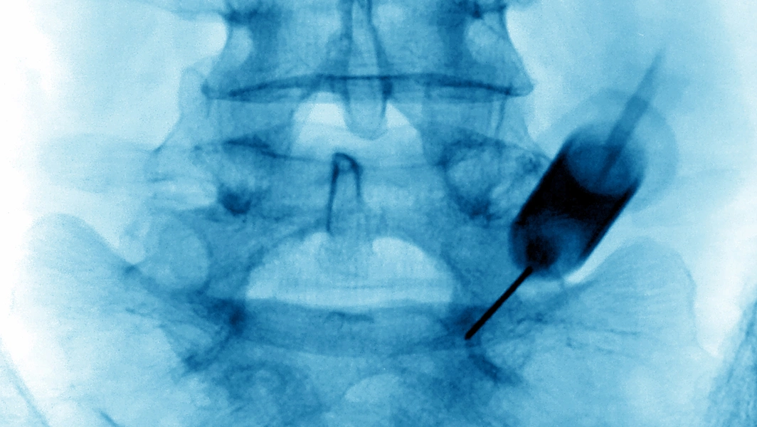 Living better with pinched nerves and radiculopathy
