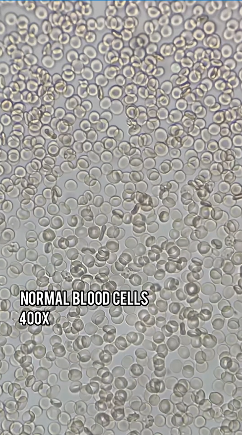 Red blood cells vs hand sanitizer under the microscope