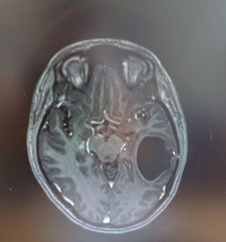 Woman remortgages home to fund treatment for terminal brain cancer