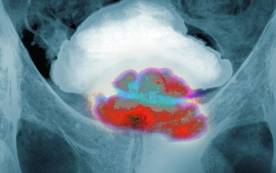 UK panel limits prostate cancer screening to rare genetic group