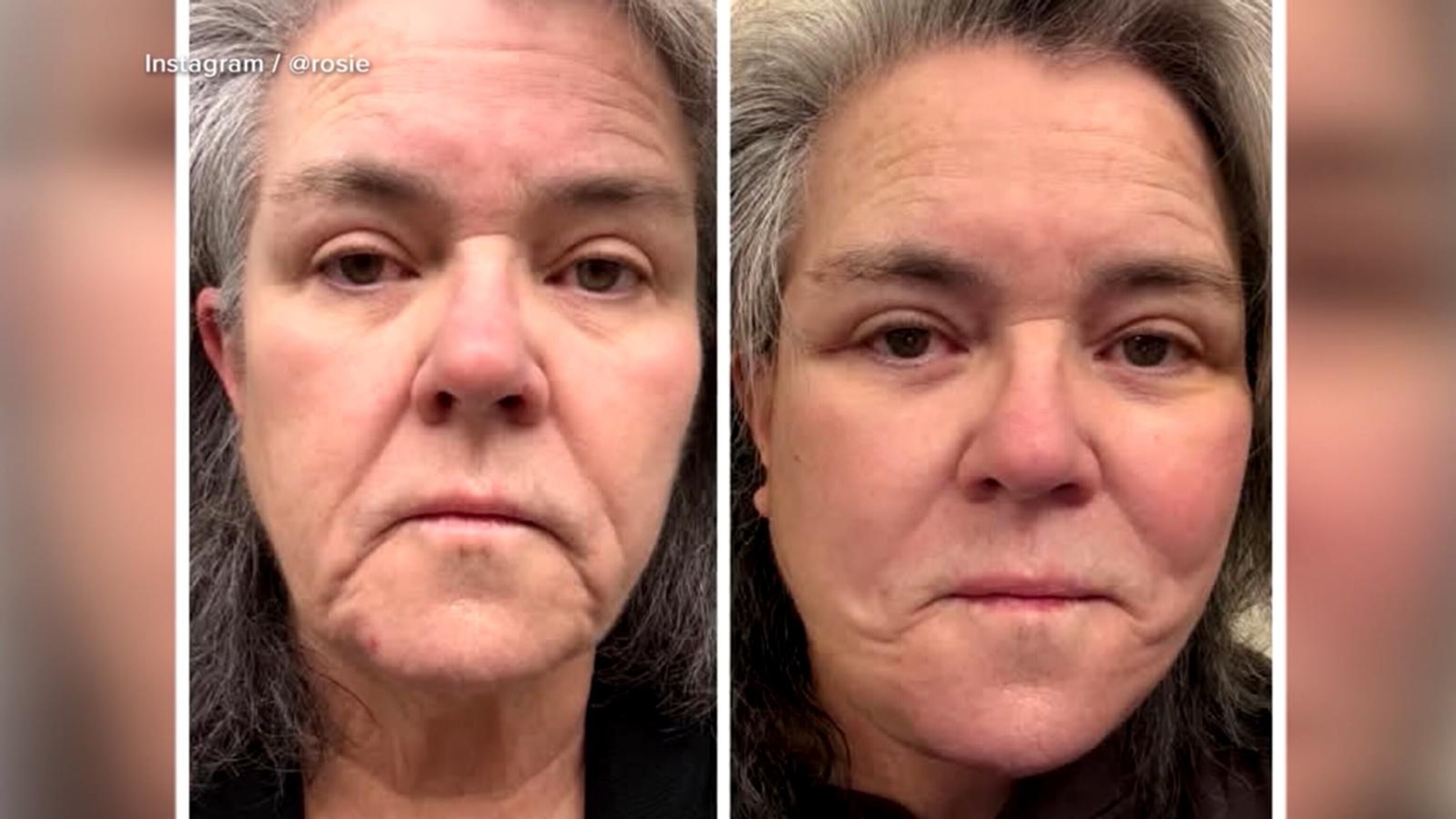 Rosie O'Donnell opens up about facelift