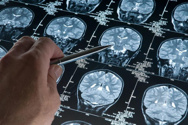 Simple blood test could reveal Alzheimer's decades before symptoms appear