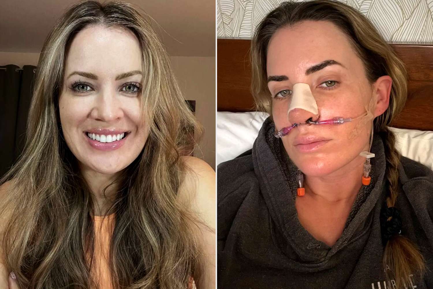 Woman says her cosmetic nose job turned into years-long battle against ...