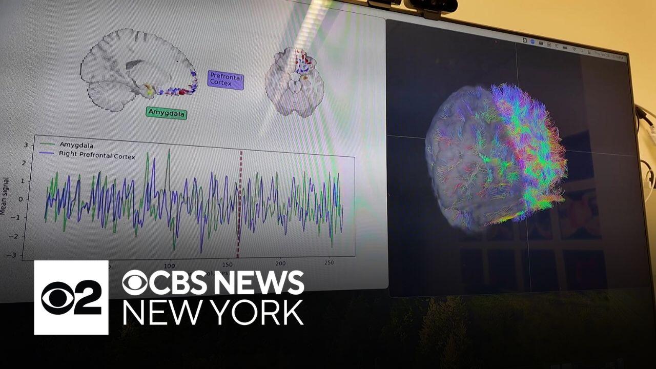 Mount Sinai study examines impact of stress on mental, physical health