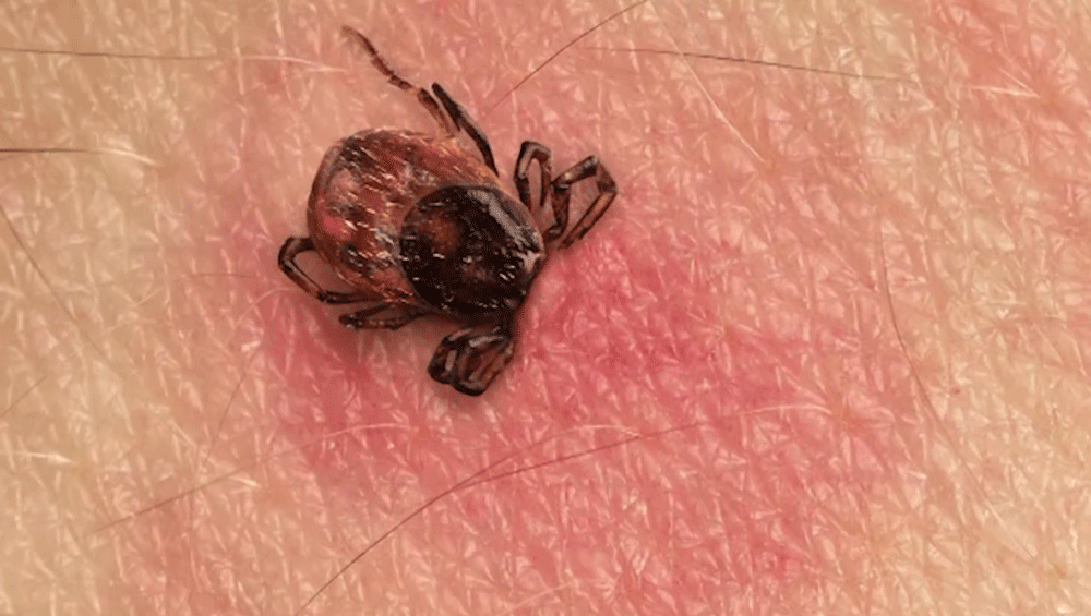 Pediatrician shares tips for identifying and treating bug bites