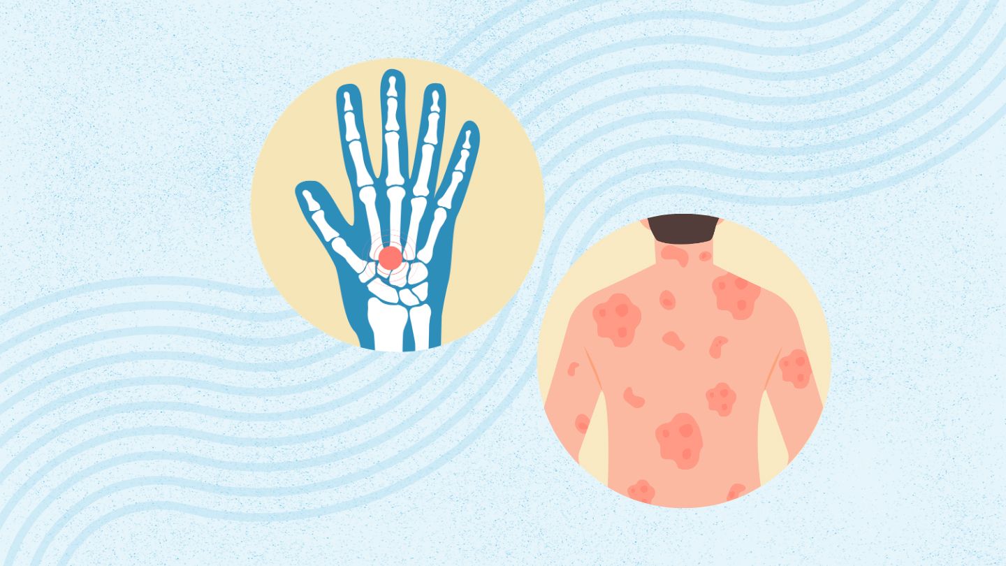 What the severity of skin symptoms says about joint health in psoriatic ...