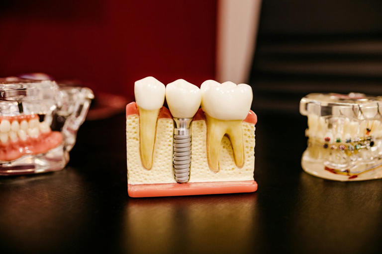 Titanium particles may explain why antibiotics fail against dental ...