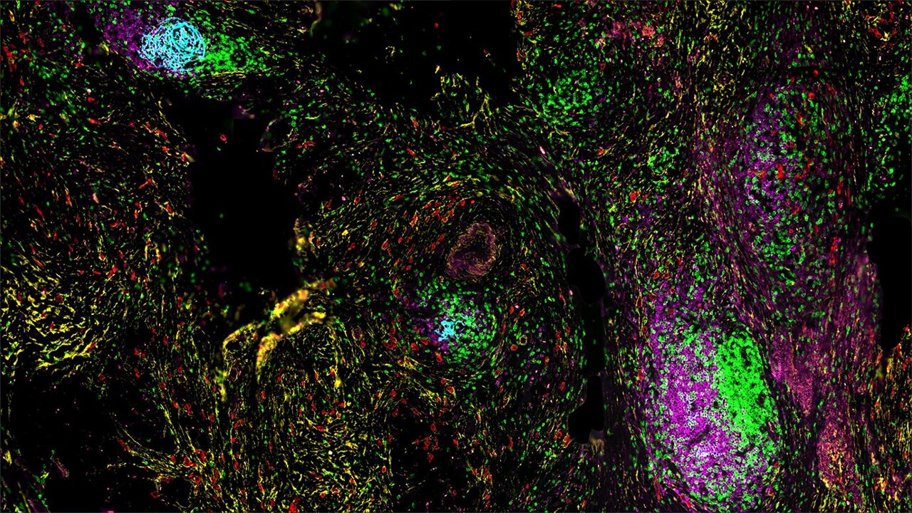 AI-powered atlas reveals new insights into tertiary lymphoid structures ...