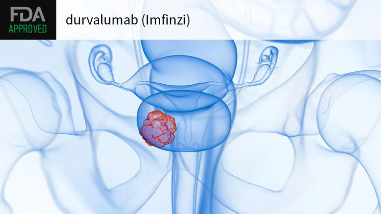 FDA OKs immunotherapy-BCG combo for high-risk bladder cancer