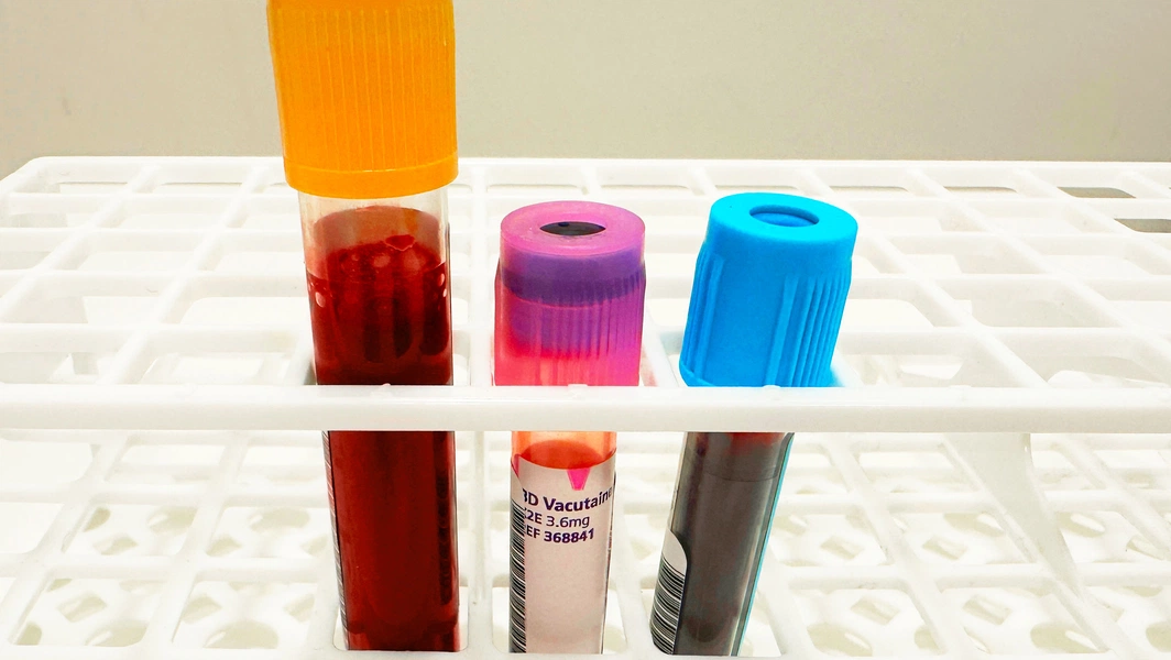 Studies show blood and brain tests detect Alzheimer’s years early