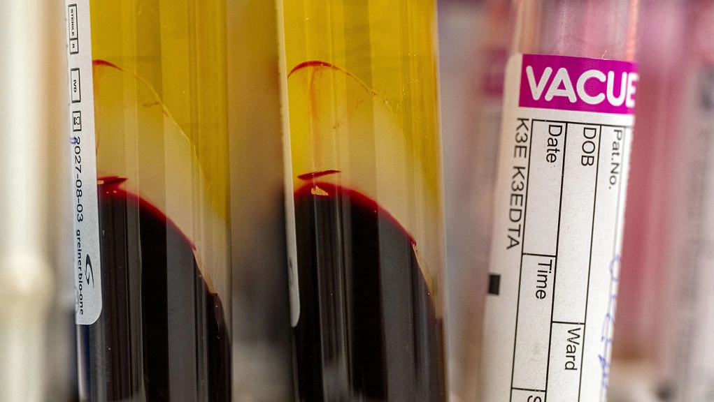 Blood test shows promise for detecting Alzheimer’s decades early