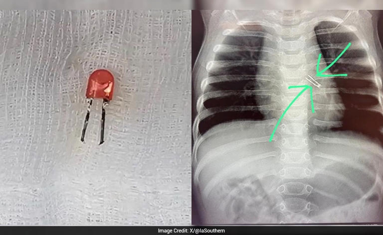 Indian Army doctors pull off miracle by removing tiny LED bulb from 9 ...