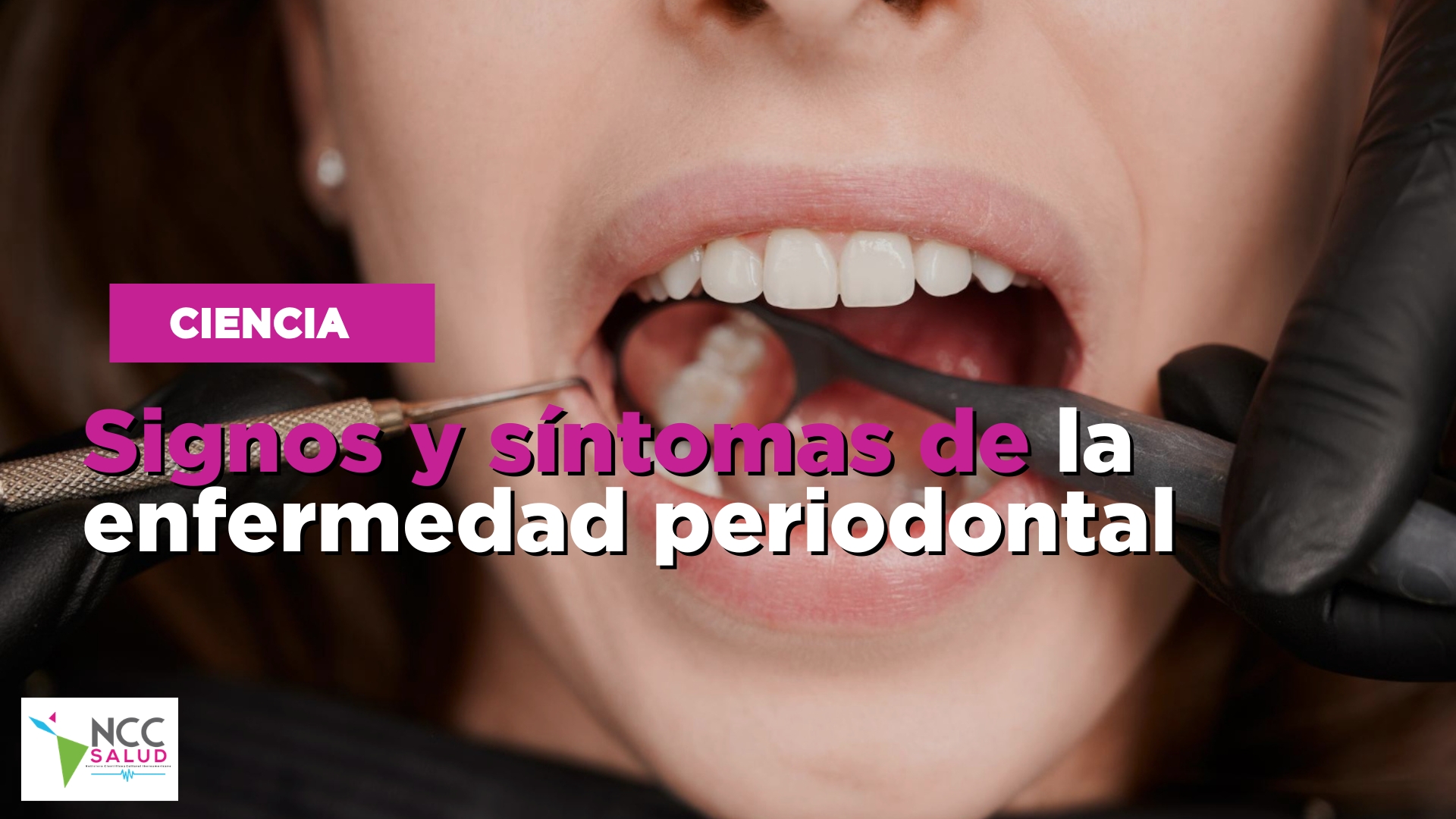 Signos y síntomas de la enfermedad periodontal