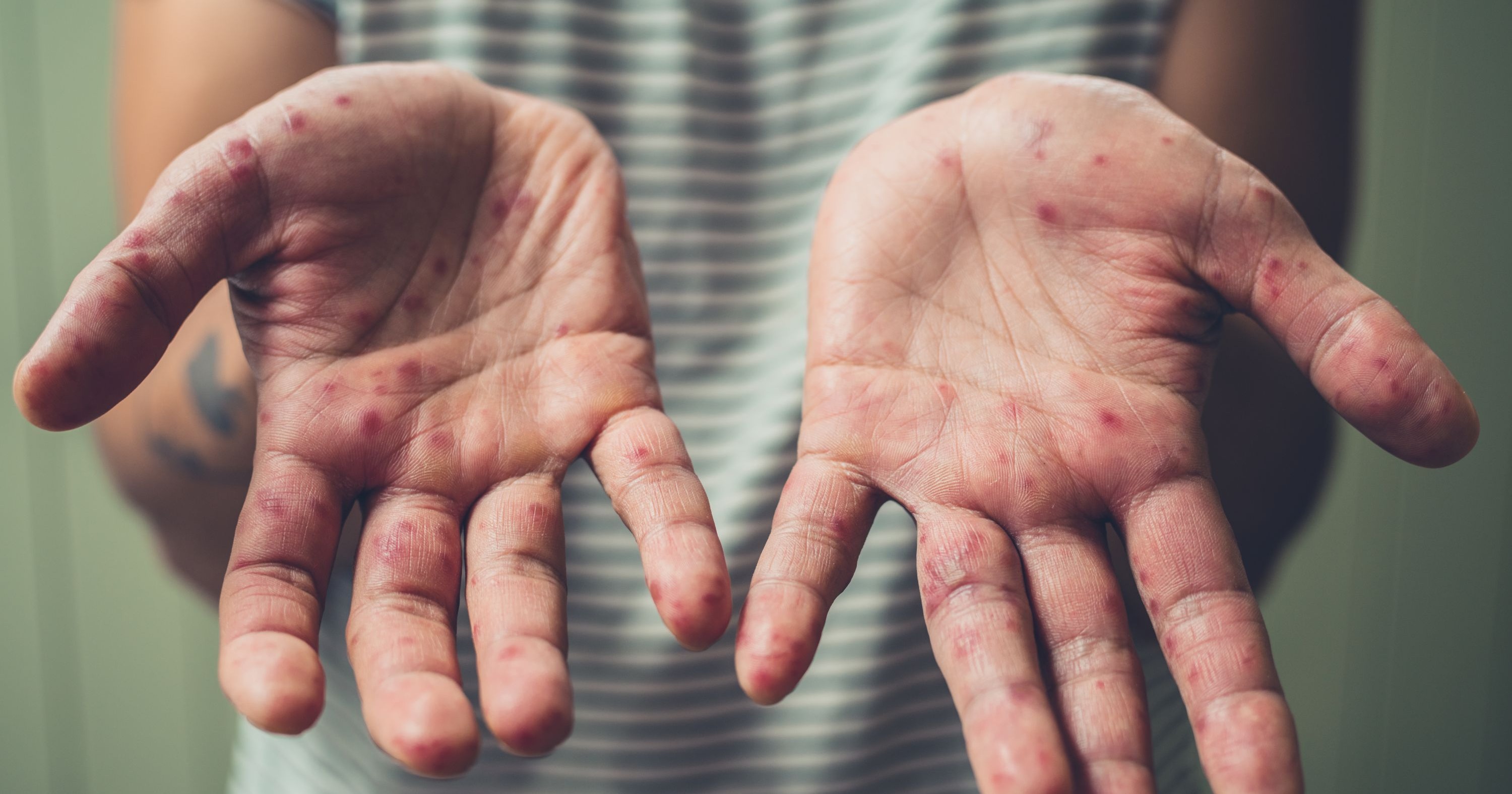PA urged to vaccinate to prevent spread of measles this summer