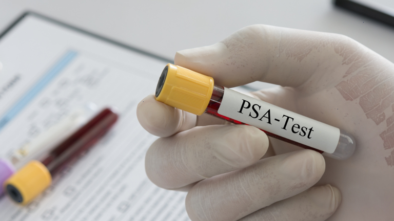 Prostate Cancer Screening In UK To Focus On High-Risk Men; Guidelines ...