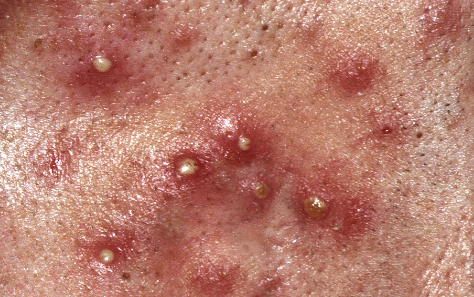 Dermatologists reaffirm benzoyl peroxide as acne gold standard