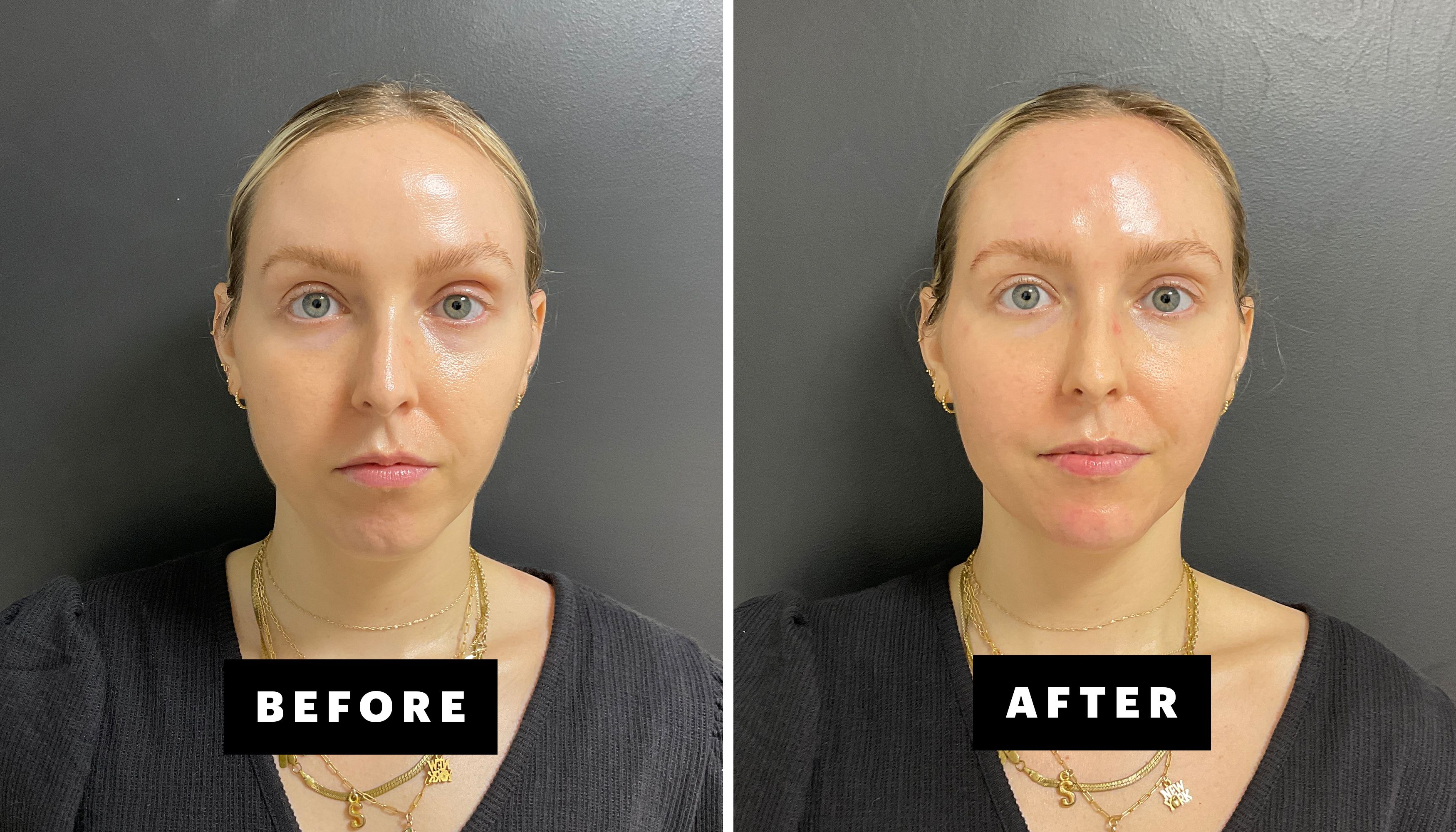 I got chin filler for my 'weak' chin