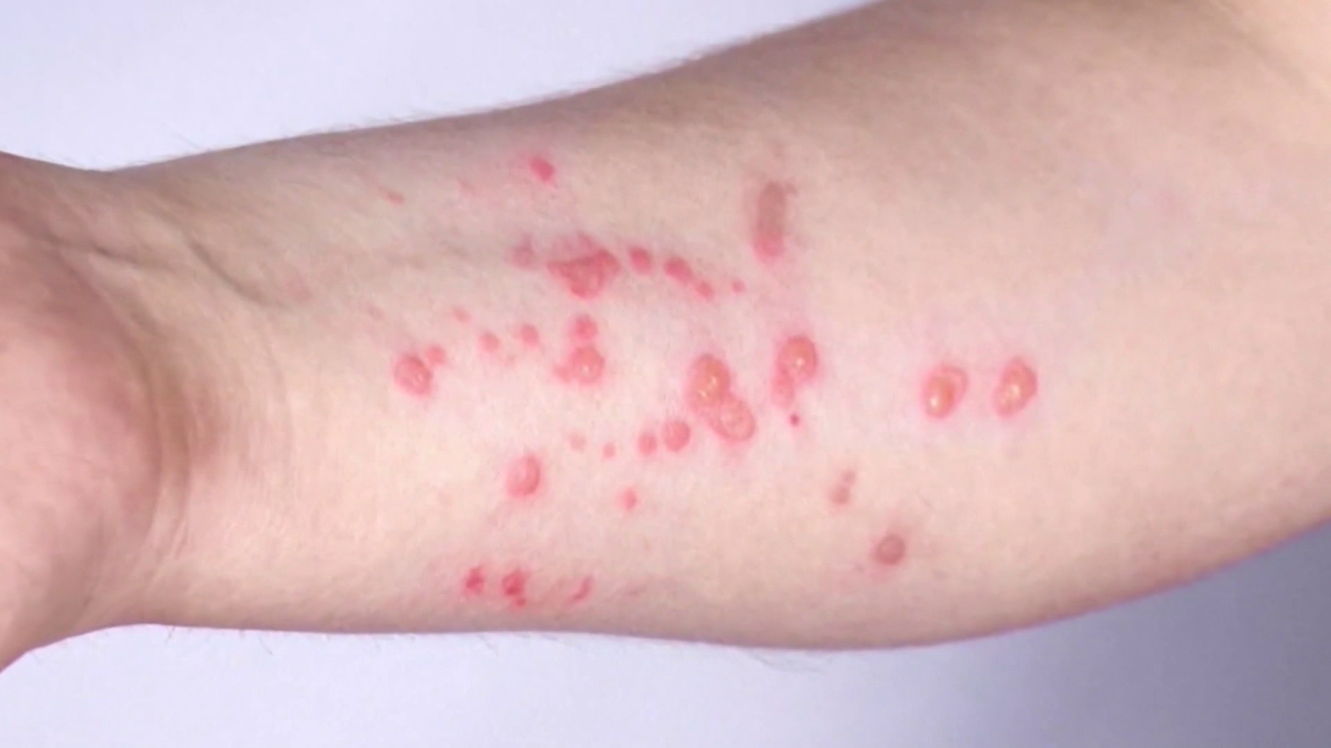 Boston residents encouraged to get MPOX vaccine amid uptick in cases
