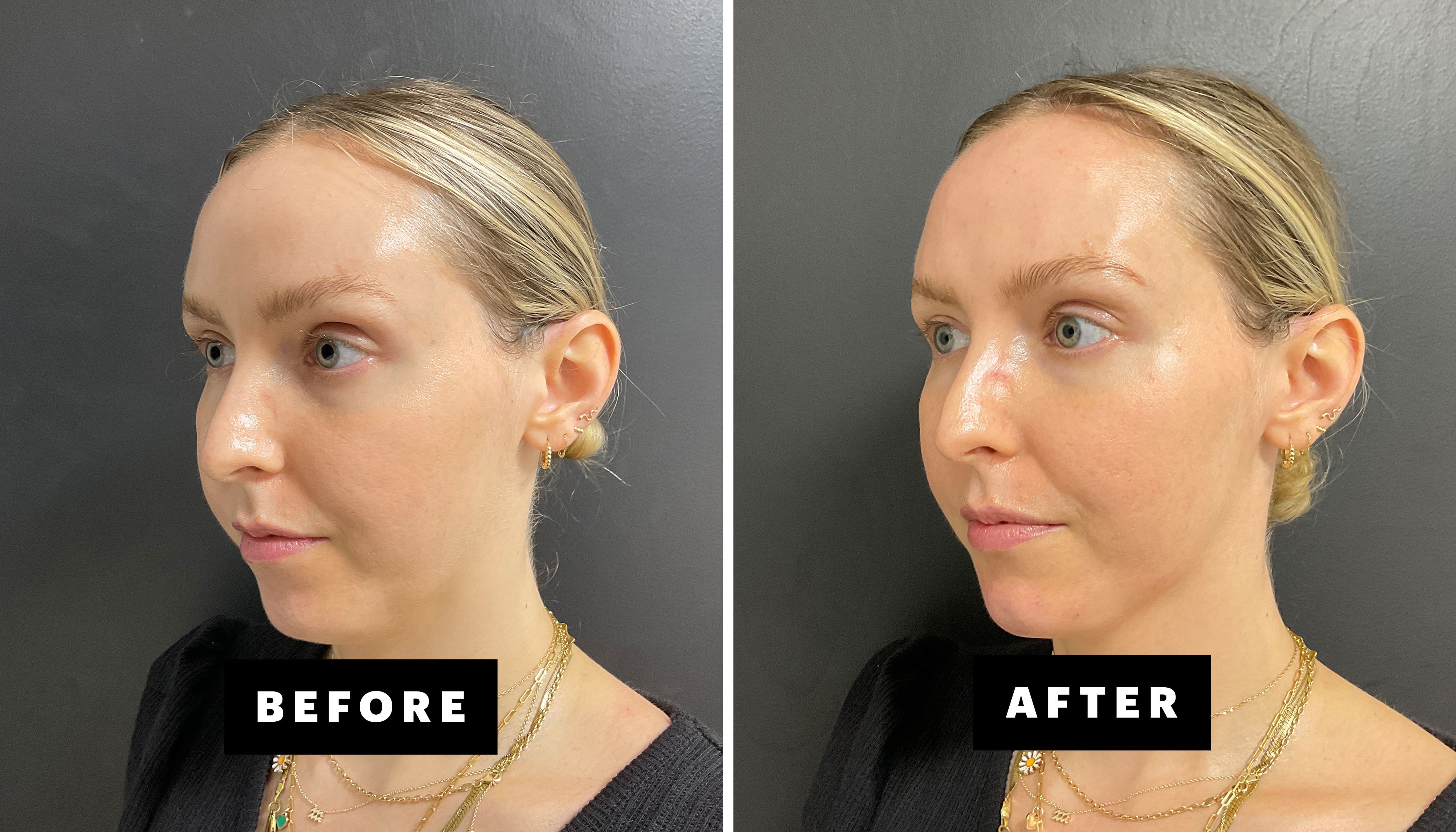 I got chin filler for my 'weak' chin