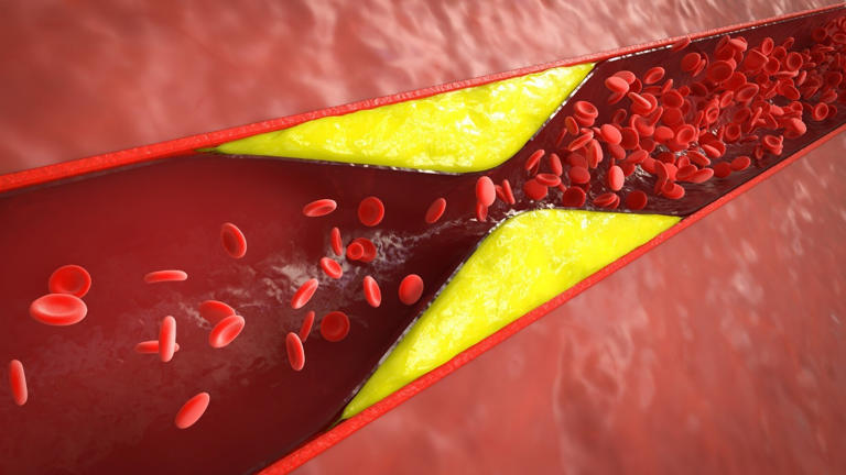 A single gene-silencing shot just cut dangerous cholesterol in half for ...